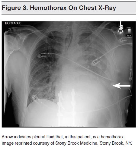 Figures And Tables | Emergency Department Evaluation And Management Of Blunt Chest And Lung ...